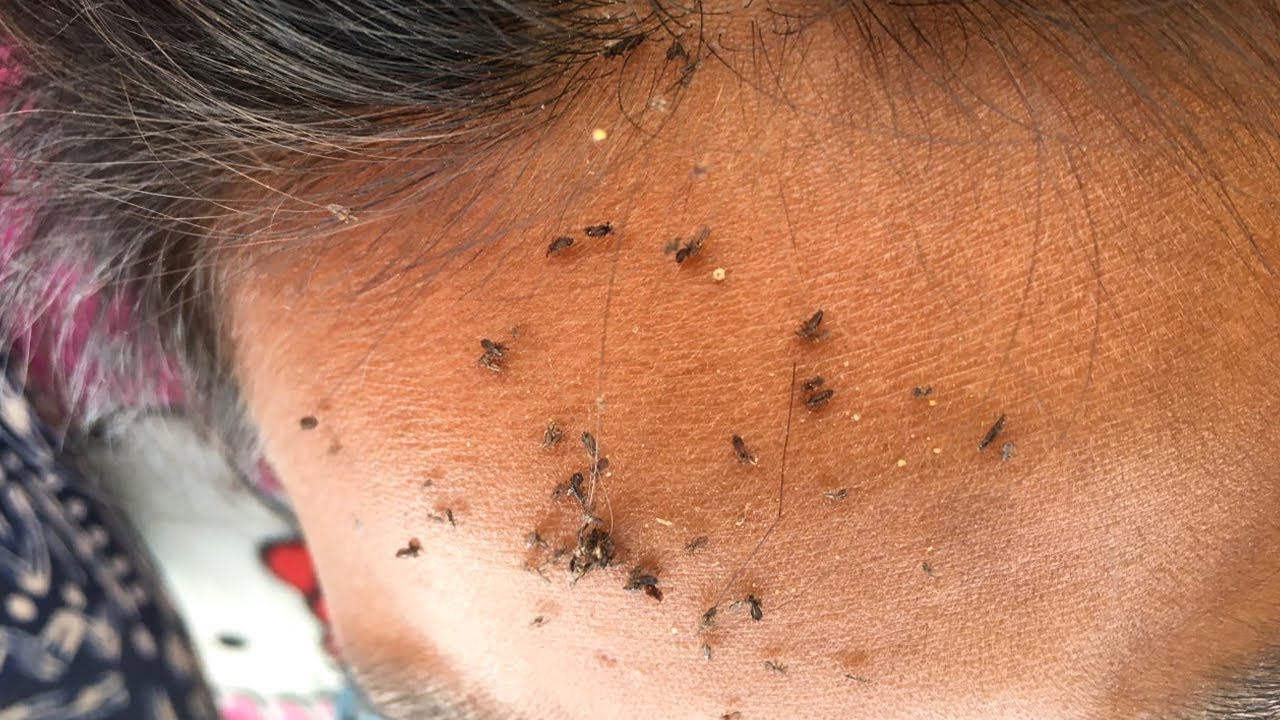 How to clear a lot of big lice - Pick out all those head lice from ...