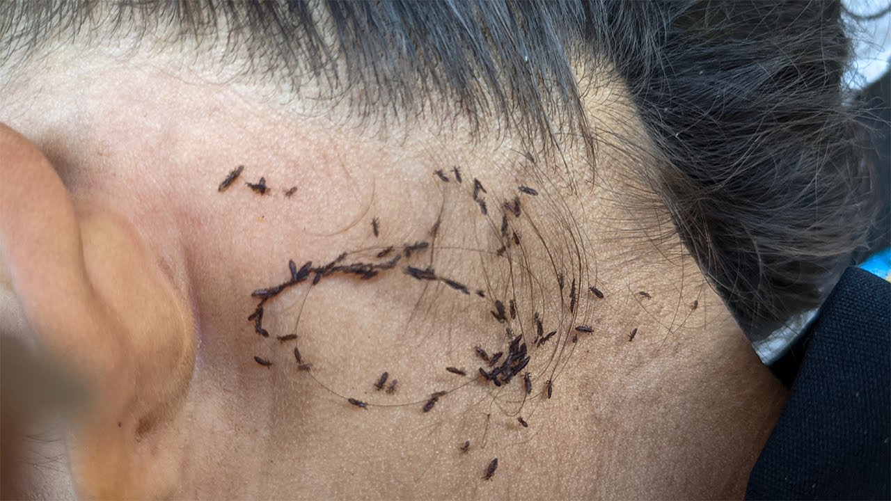 Remove all thousand lice from head - Getting out all of head lice - YouTube