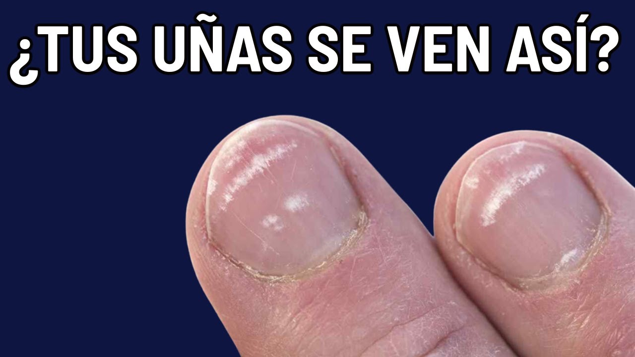 TUS UÑAS TE AVISAN QUE ESTÁS ENFERMO - 12 datos de enfermedad sistémica ...