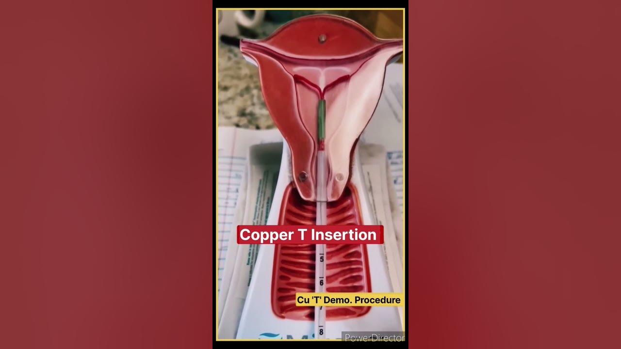 Copper T Insertion Demo Procedure Iucd Short Neet Medical