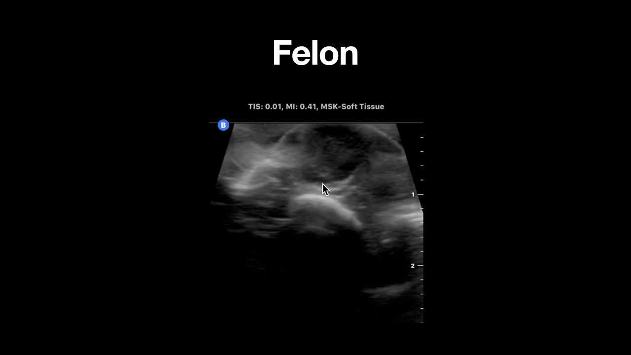 Identification of A Felon Using Ultrasound - YouTube