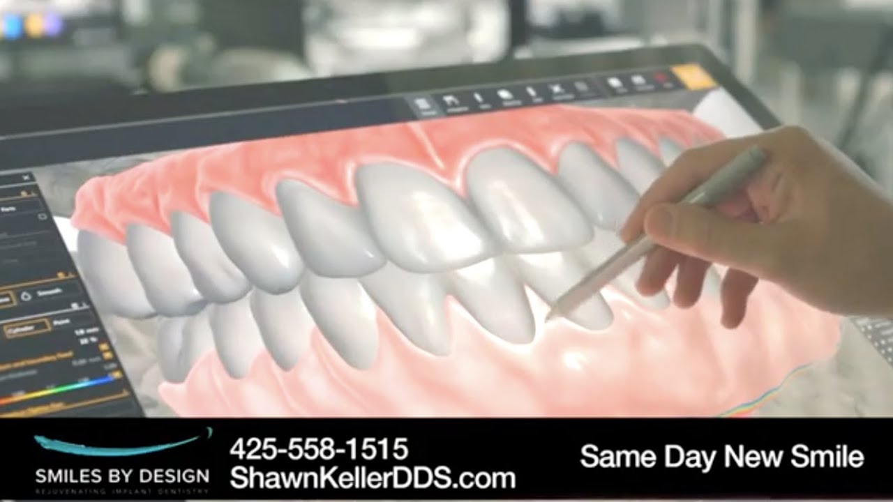 Same Day New Smile™| Dental Implants Explained - YouTube