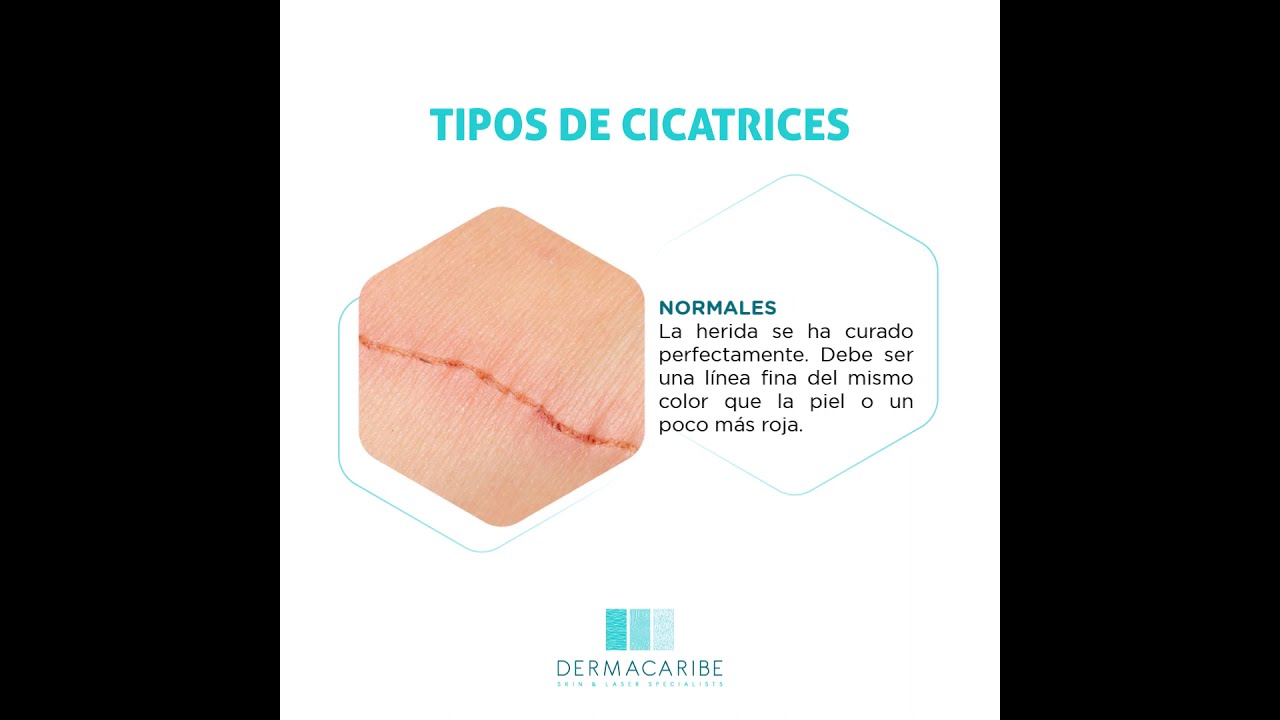 TIPOS DE CICATRICES - YouTube