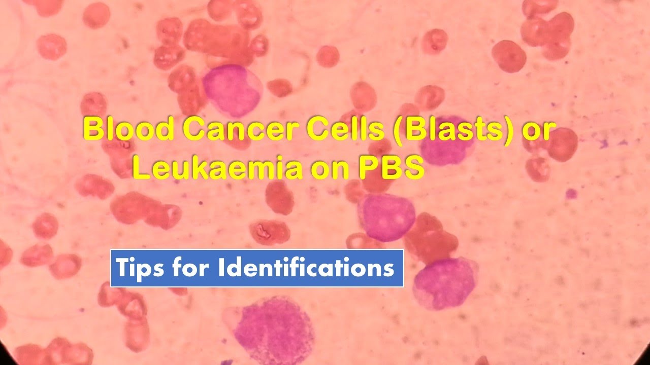 Blood Cancer Cells ( Blasts) or Leukemia on Peripheral Blood Smear ...