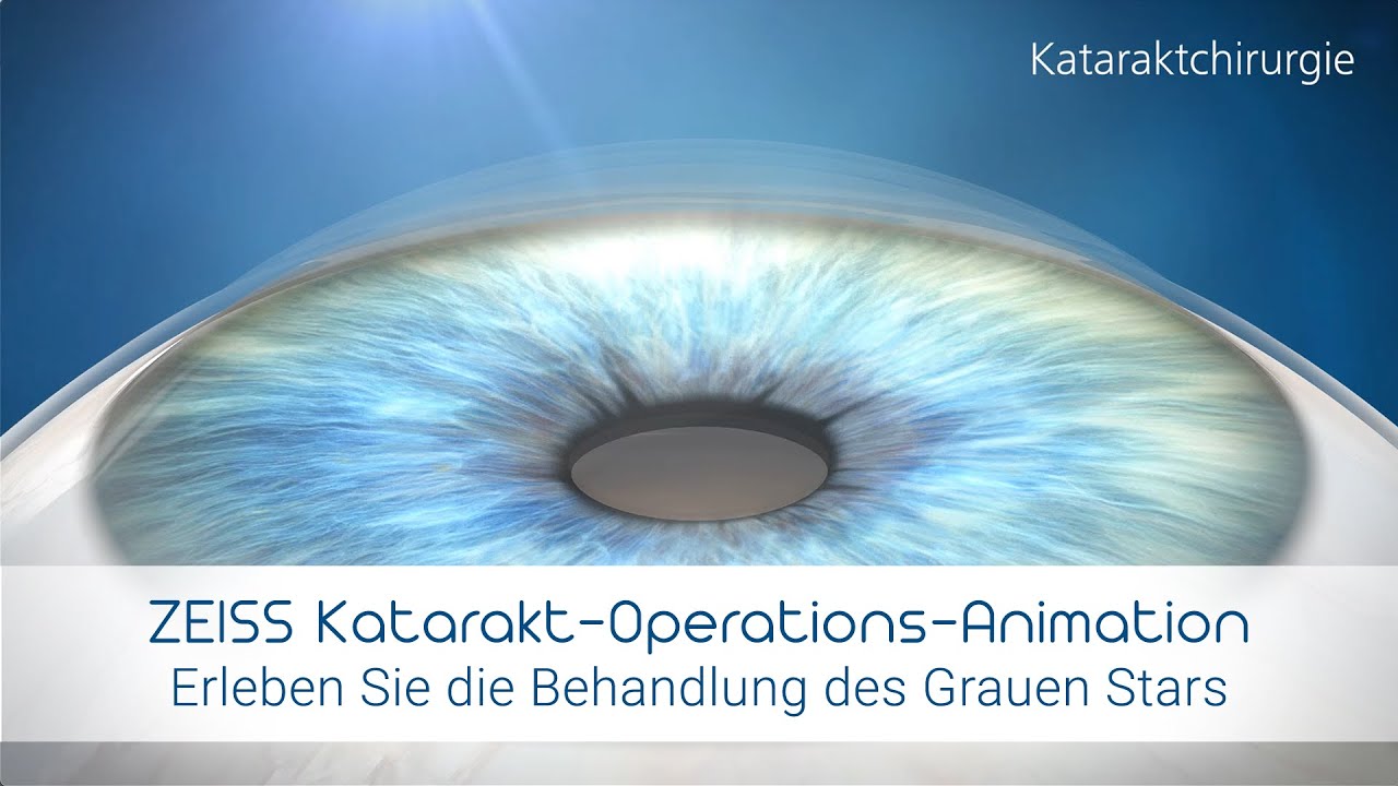 ZEISS Katarakt-Operation Animation - YouTube