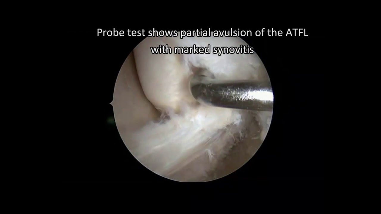 All-Inside Arthroscopic Brostrom-Gould Procedure - YouTube