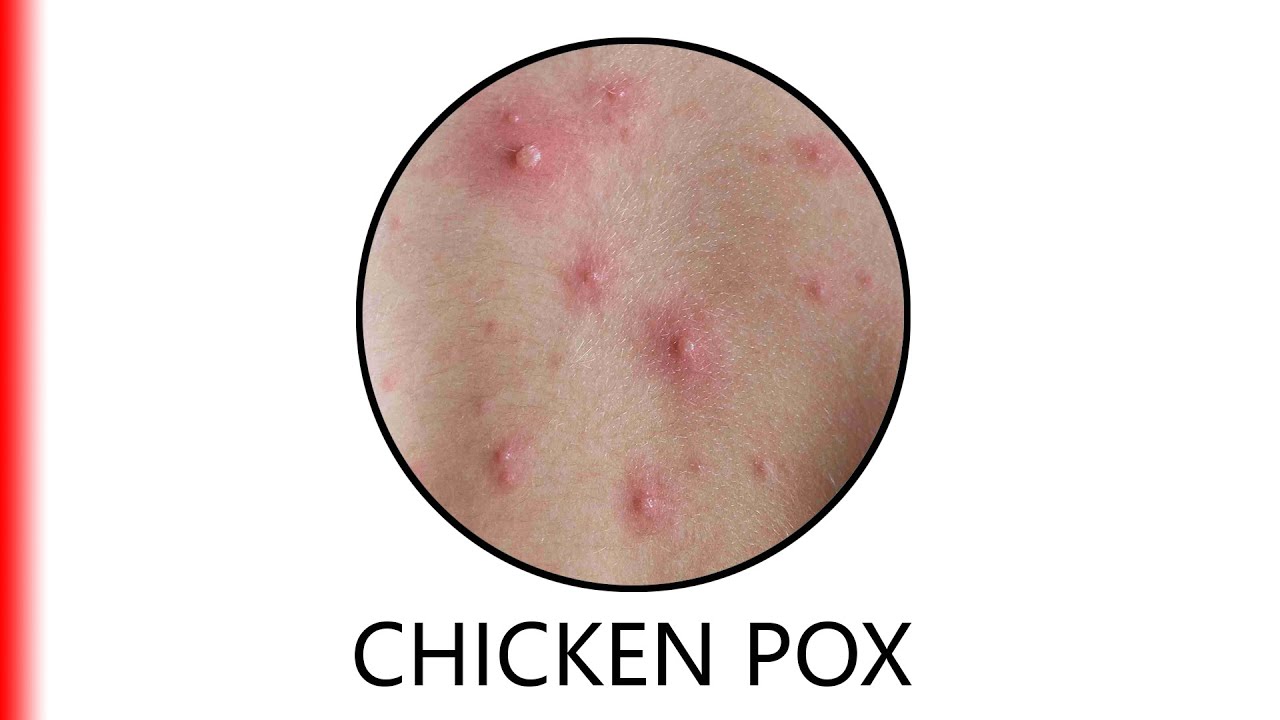 CHICKEN POX. - YouTube
