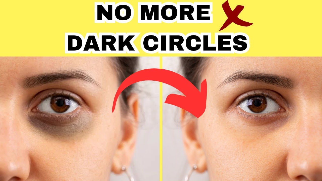 How To Remove Dark Circles Naturally In 3 Days Dark Circles Homemade how-to-remove-dark-circles-naturally-in-3-days-dark-circles-homemade