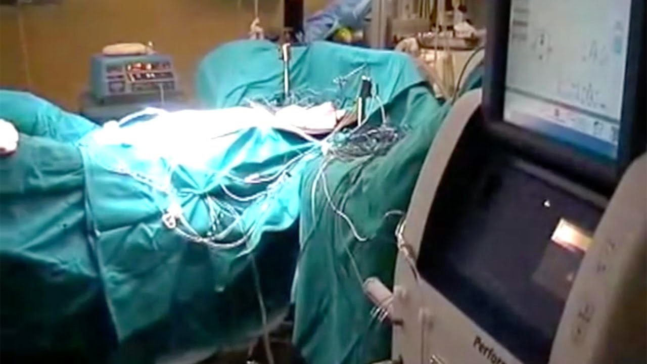 Cytoreductive surgery and HIPEC - Dr. Deraco - Milan (Italy) - YouTube