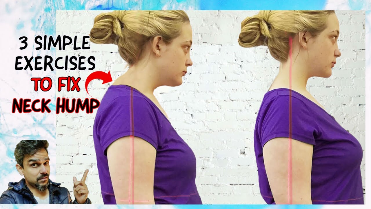 Fix NECK HUMP & Pain with 3 Simple Exercises - YouTube