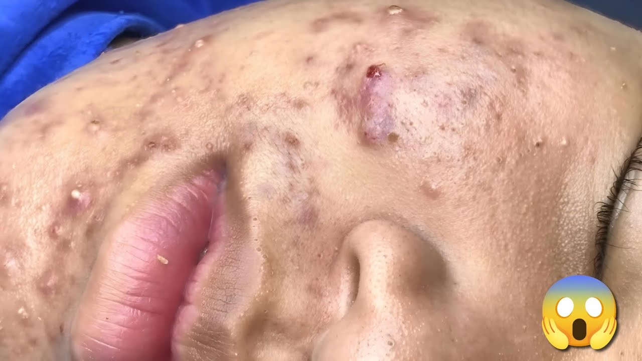 "Ultimate Pimple Popping Satisfaction – Watch the Explosion!"# ...