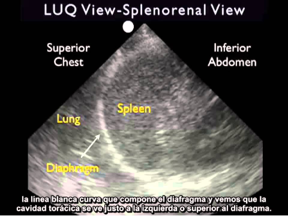 Realizar un examen FAST para detectar traumatismos - Examen del ...