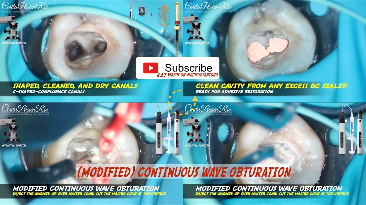 continuous wave obturation c-shaped confluence canals molar fastfill ...