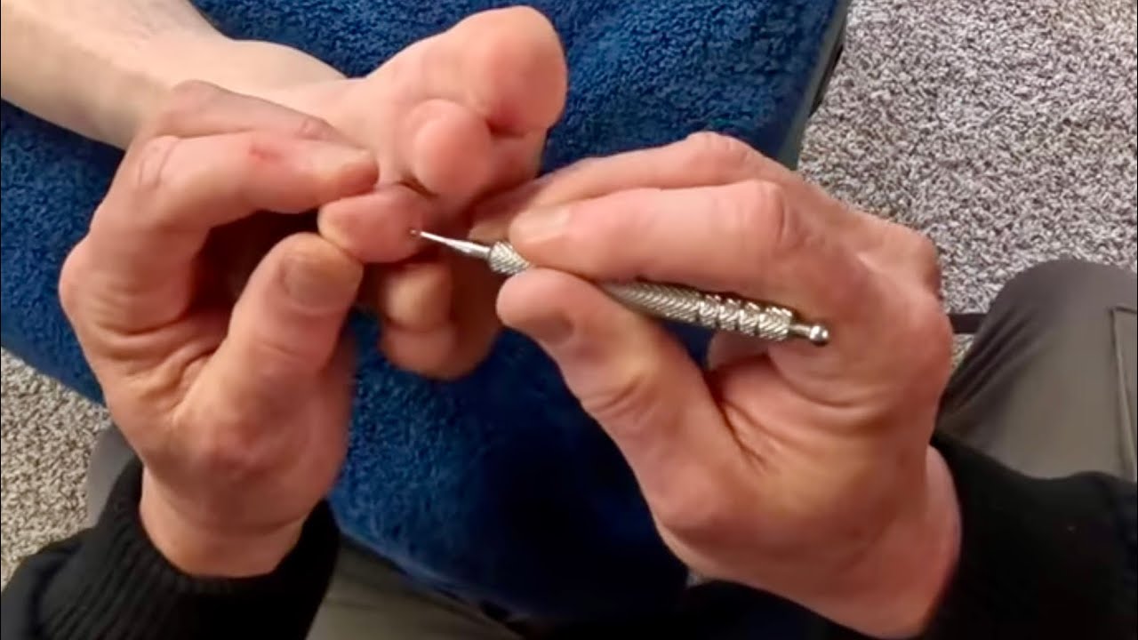 Foot massage using acupressure pen to get fine detailed pressure. Rock ...