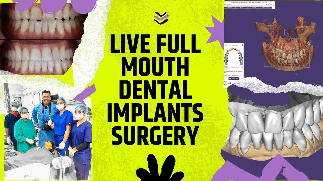 Live full mouth dental implants surgery | full mouth dental implants ...