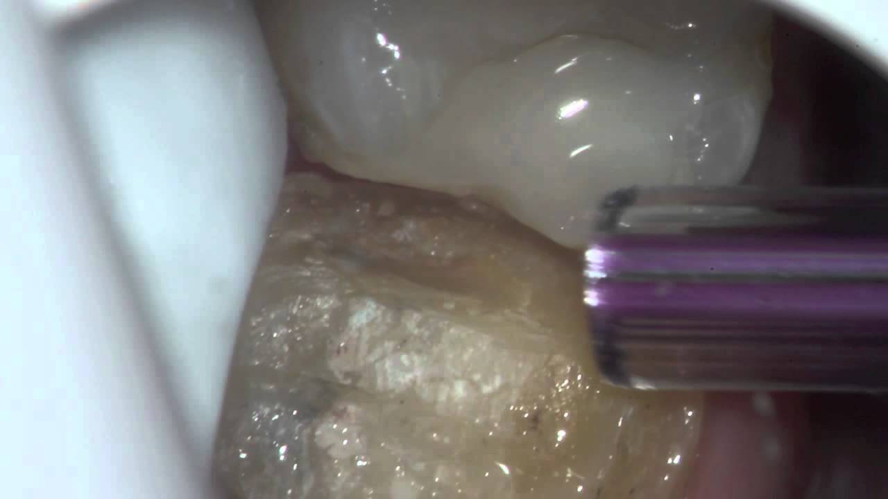 crown has plaque underneath - YouTube