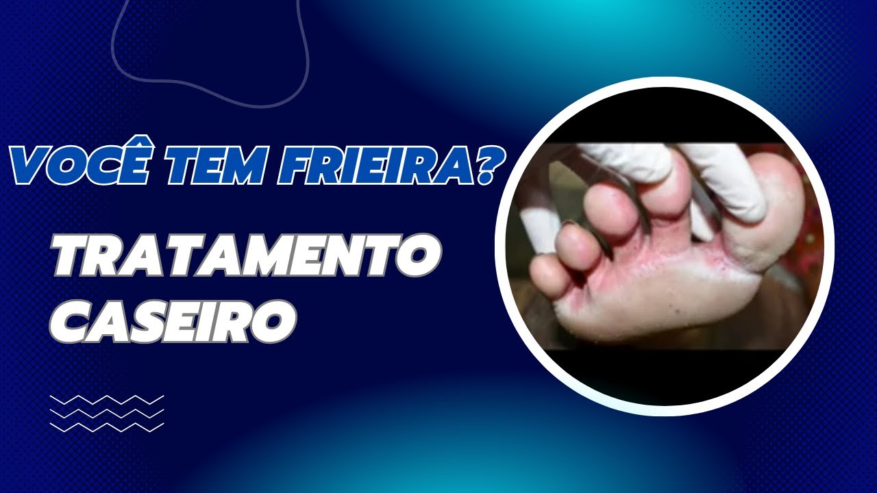 Fim da Frieira com Tratamento Caseiro - #jonathaspodologo #podologia # ...