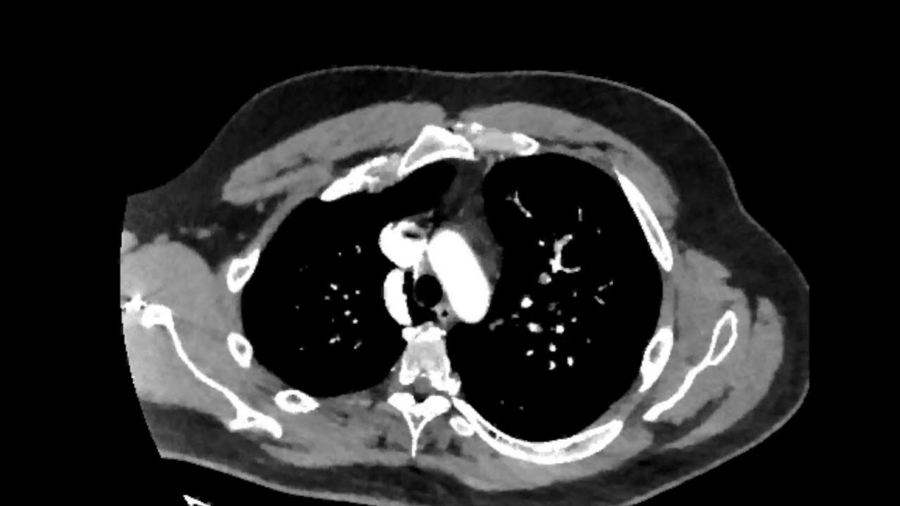 Saddle Pulmonary Embolism
