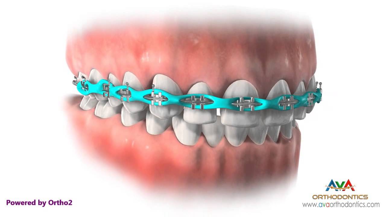 Orthodontic Treatment For Spacing Different Stages YouTube orthodontic-treatment-for-spacing-different-stages-youtube