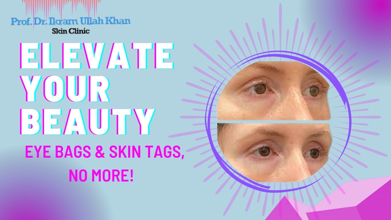Unveiling the Secret to Get Rid of Skin Tags or Eye Bags! # ...