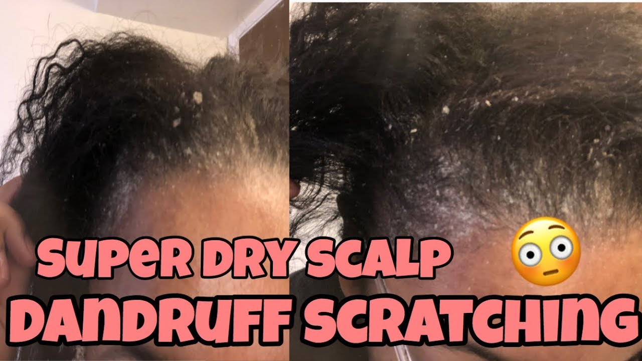 HUGE FLAKES!! *Close Up* Scratching Dandruff - YouTube