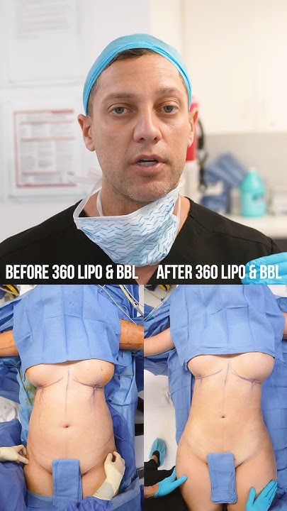 Total Body Makeover with BBL & 360 Liposuction: Stunning Results - YouTube