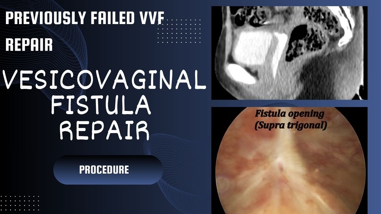 VVF repair | Recurrent Vesico-vaginal Fistula repair | VVF Surgery ...