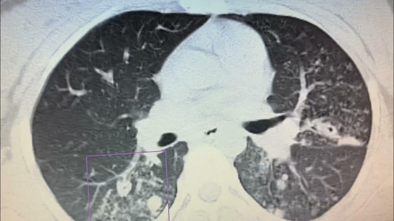 Tree in bud pattern - YouTube