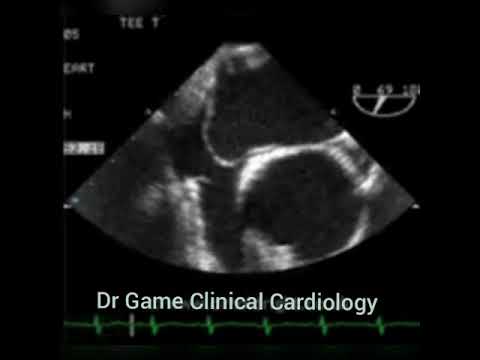 PFO - Patent Foramen Oval - Bubble study - Contrast - TEE - Echo Clip ...