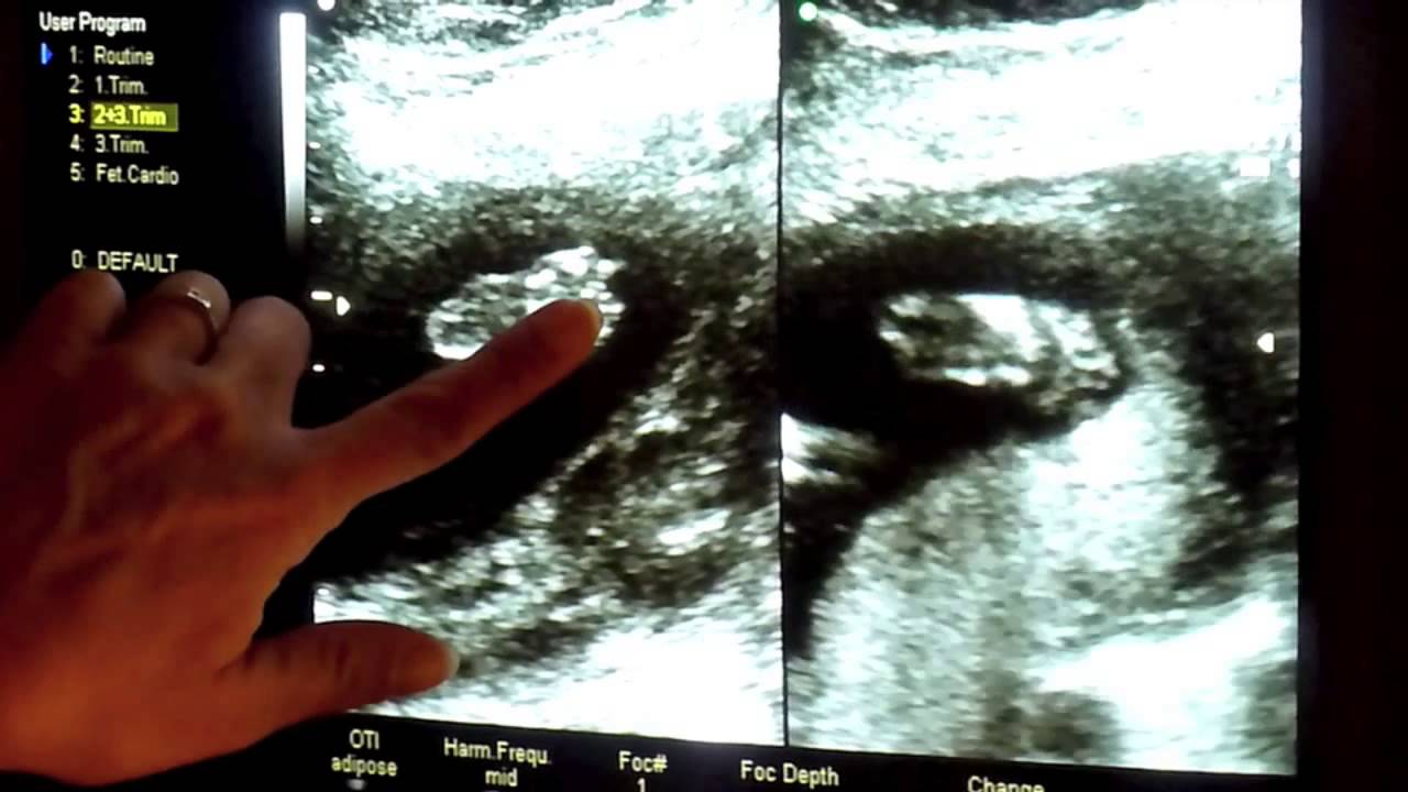 20 Weeks Ultrasound Girl