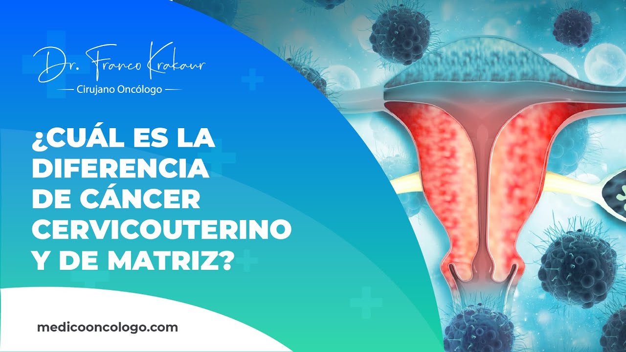 ¿Diferencia De Cáncer Cervicouterino Y De Matriz? | Dr. Franco Krakaur ...