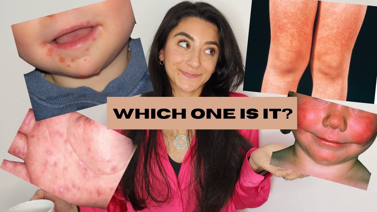 Pediatric rash- which one is it? | Doctor explains - YouTube