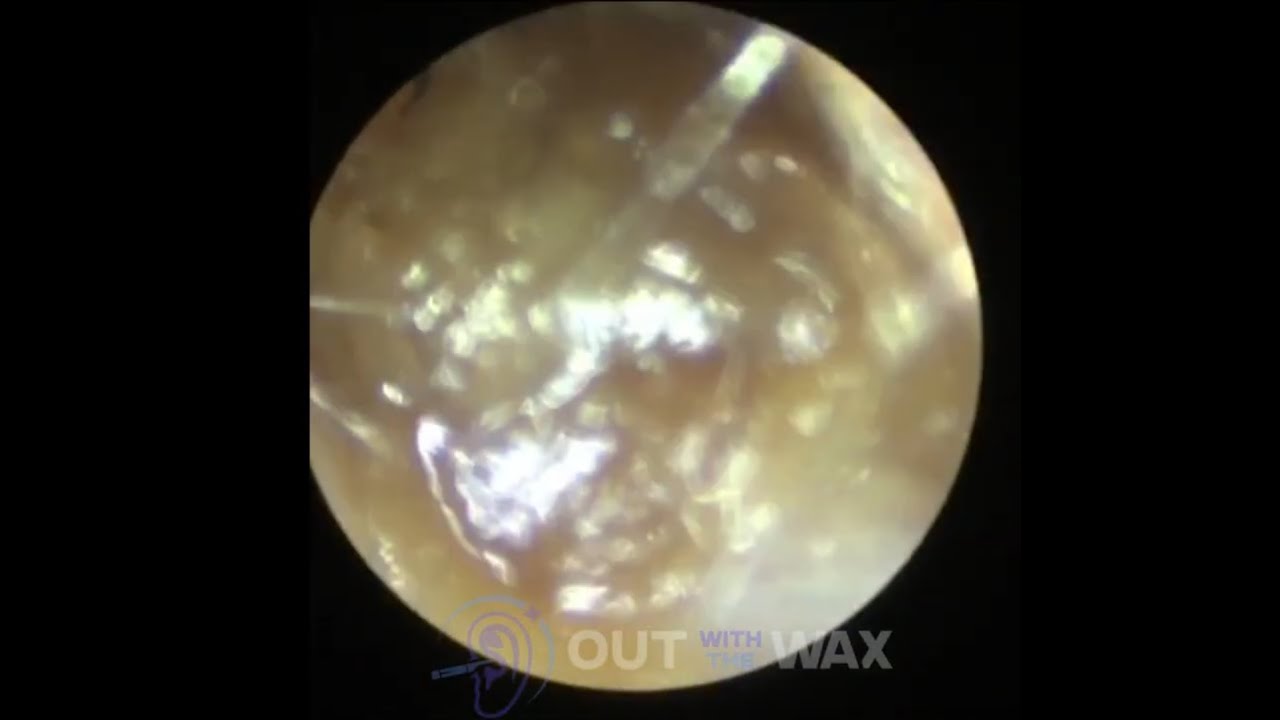 Satisfying Earwax Removal from Both Ears | Soft, Shiny Wax & Dry Skin ...