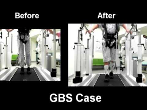 Before After GBS patient - YouTube