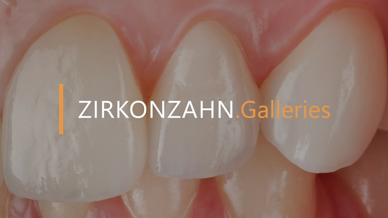 Ultra-thin veneers in Prettau® 4 Anterior® Dispersive® | Zirkonzahn ...