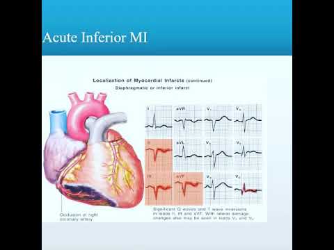 12-Lead EKG | Acute Inferior MI - YouTube