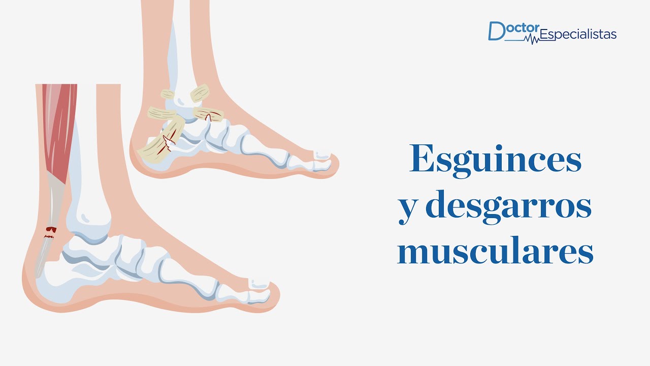 Esguinces y Desgarres Musculares - Doctores Especialistas - YouTube