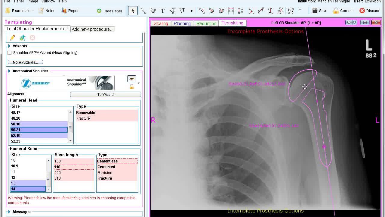 Total Shoulder | Joint Replacement | Materialise OrthoView - YouTube