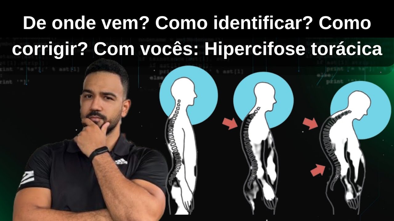 De onde vem? Como identificar? Como corrigir? Com vocês, a hipercifose ...