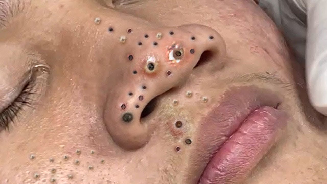 Big Blackhead on Nose , blackheads extraction ,nose extraction - YouTube