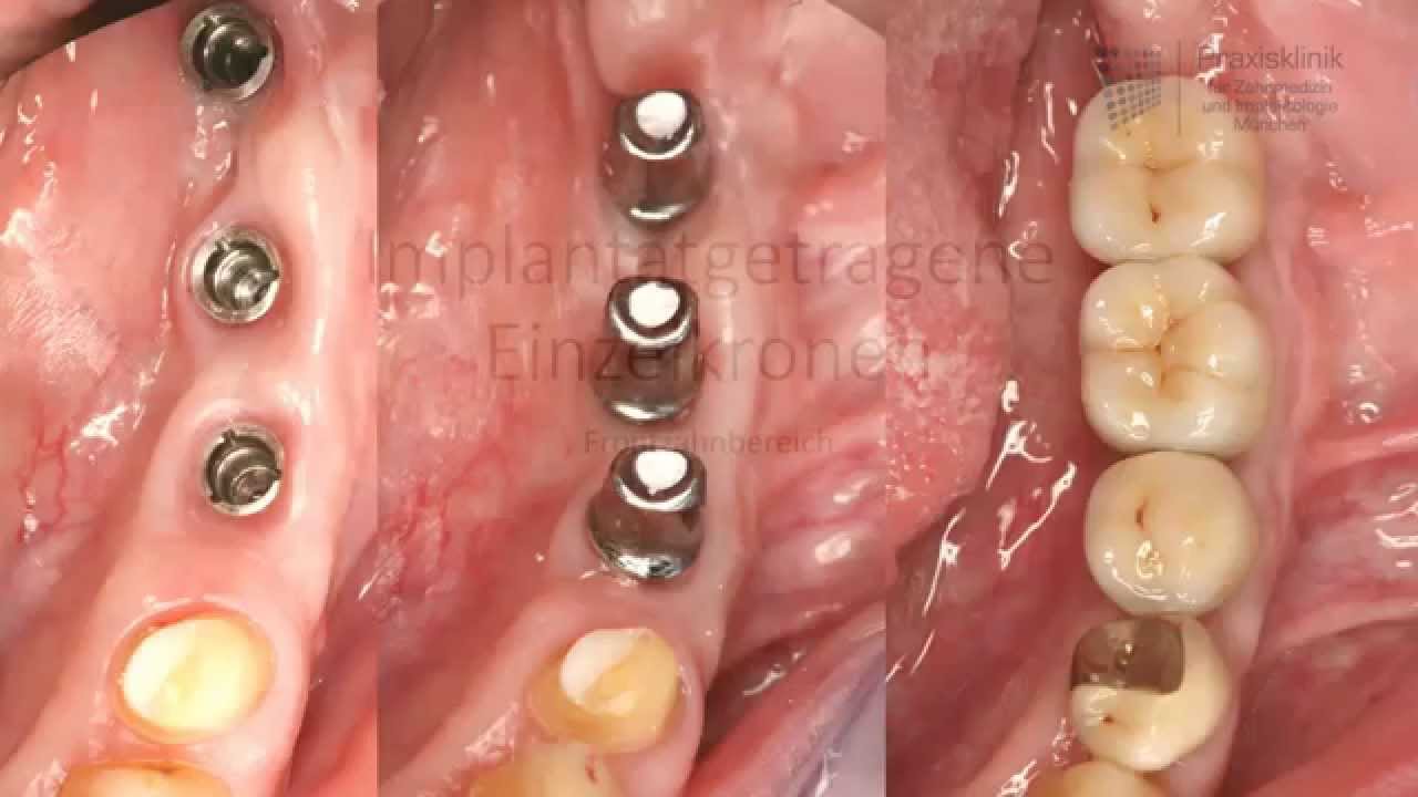 Zahnimplantation - Wie funktioniert moderne Implantatprothetik? - YouTube