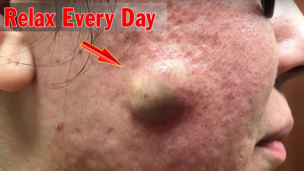 Relax Every Day With Sac Dep Spa #0020 | Blackheads And Pimples - YouTube