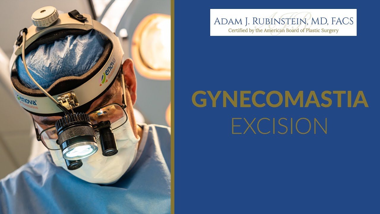 Dr. Adam J. Rubinstein Preforms an Excision of the Gynecomastia - YouTube