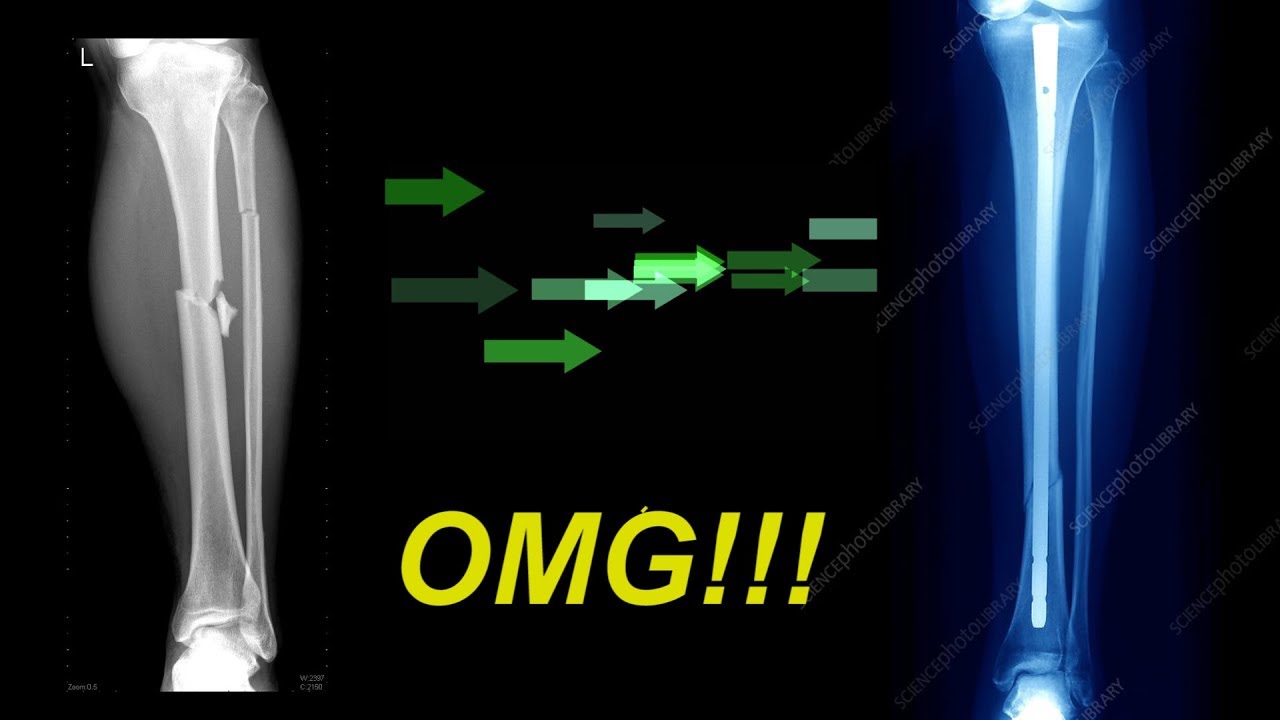 4 Months After HORROR LEG BREAK - YouTube