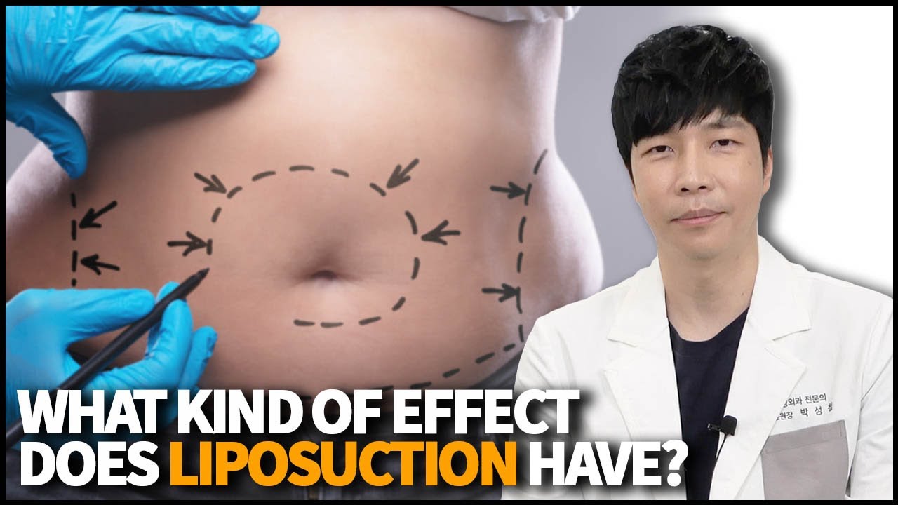 Liposuction: Everything You Need to Know with Doctor Park - YouTube