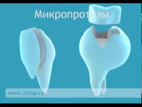 Зубные протезы. Виды зубных протезов и их особенности - YouTube