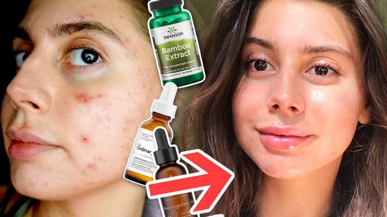 MORNING SKINCARE ROUTINE for GLASS SKIN ACNE PRONE FRIENDLY || Skincare ...