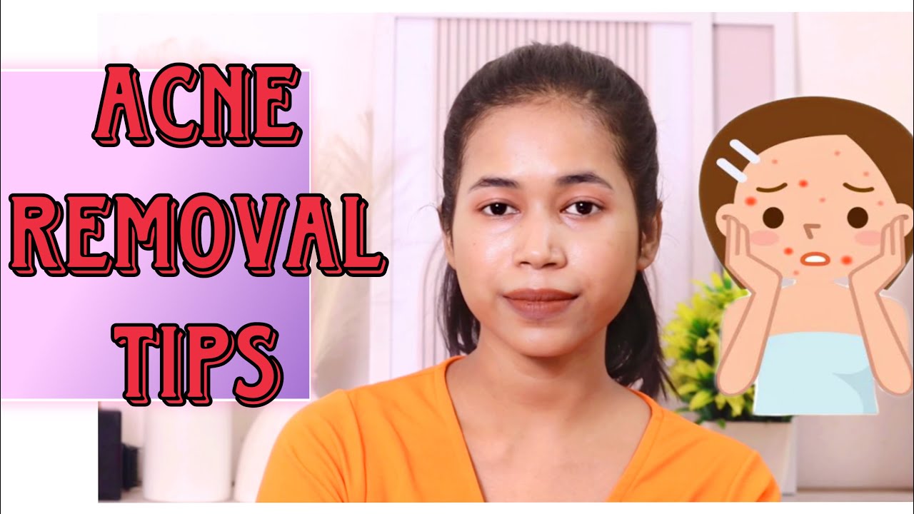 Acne removing tips and tricks - YouTube