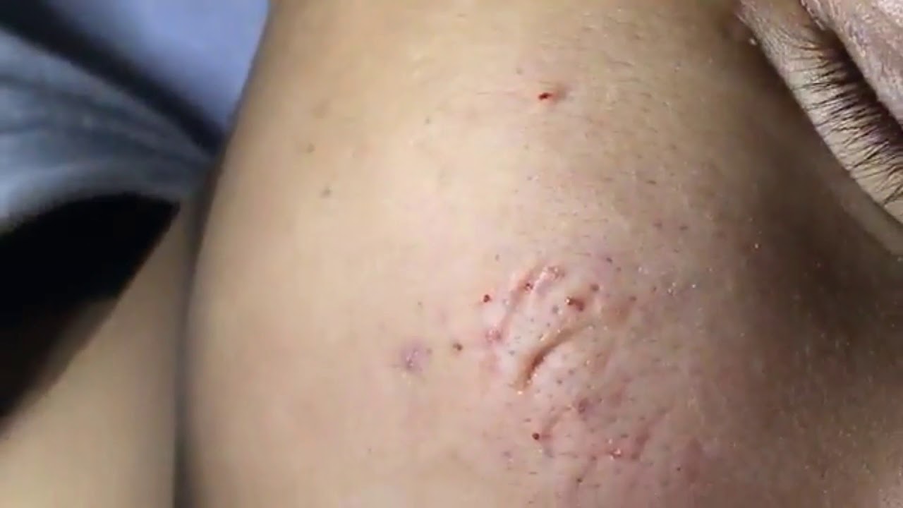 Get hidden acne Remove acne with a knife - Lấy mụn ẩn dưới da bằng một ...