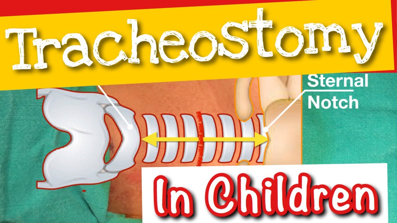 Pediatric Tracheostomy in a 7 year old child. Dr Tamer Ashraf Wafa ...